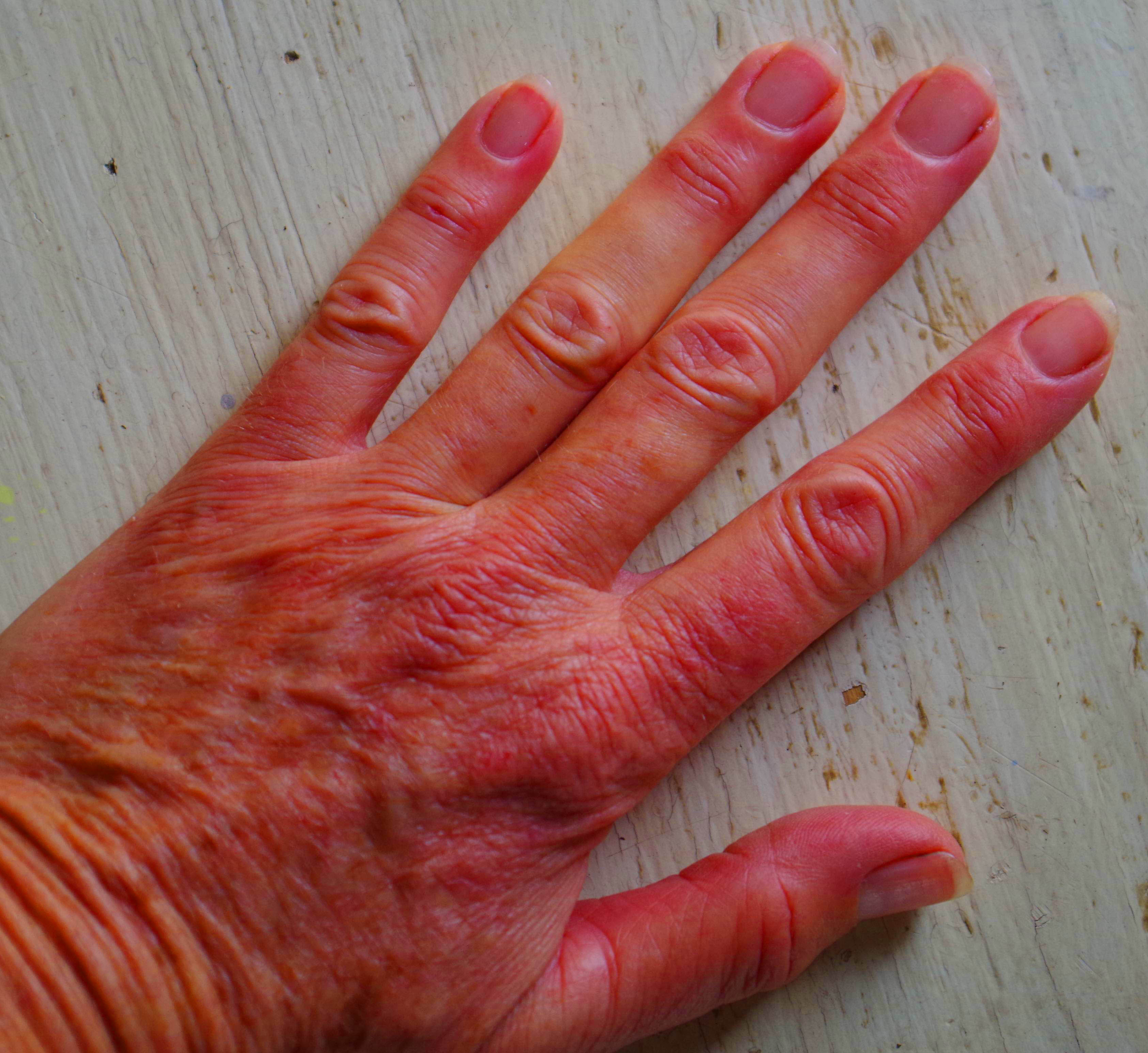 LA MALADIE DE RAYNAUD